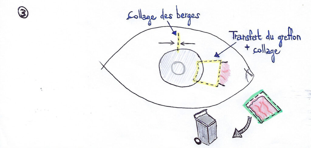 Dr Leininger - L’opération